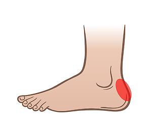 Foot Deformity – Haglund’s Deformity | Berta Strow